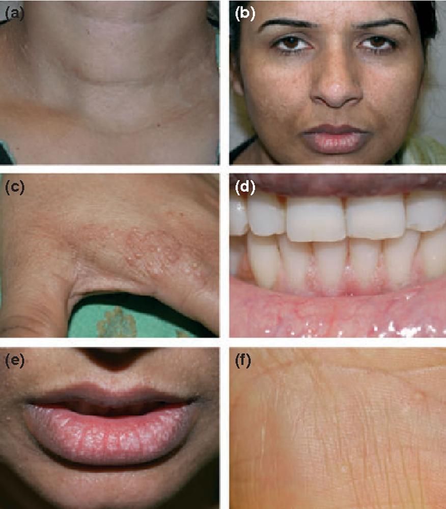 Prof. Dr. Haydar BAĞIŞ / Cowden Sendromu (PTEN Hamartom Tümör Sendromu)